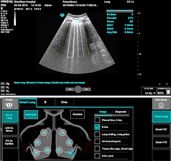 ¿Qué es la Tecnología SMART B-LINE de Mindray?