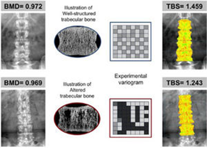 ¿Qué es el TBS (Trabecular Bone Score) y cómo funciona?